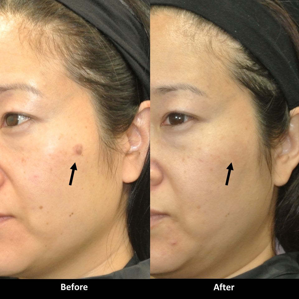 Micro Laser Peel – A E Skin